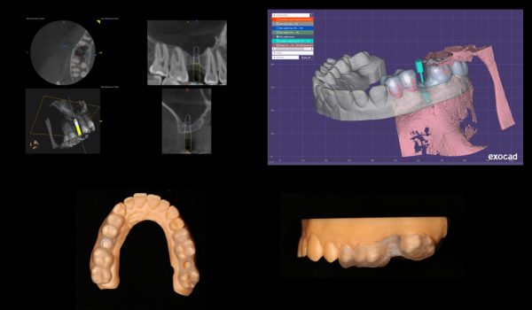 Biometric Cad/Cam Library for Exocad – Biometric